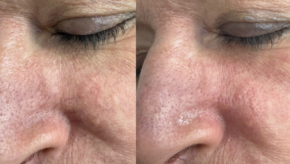 Facial Thread Vein Treatment In Amersham
