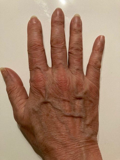Hand Vein Removal Treatment Amersham